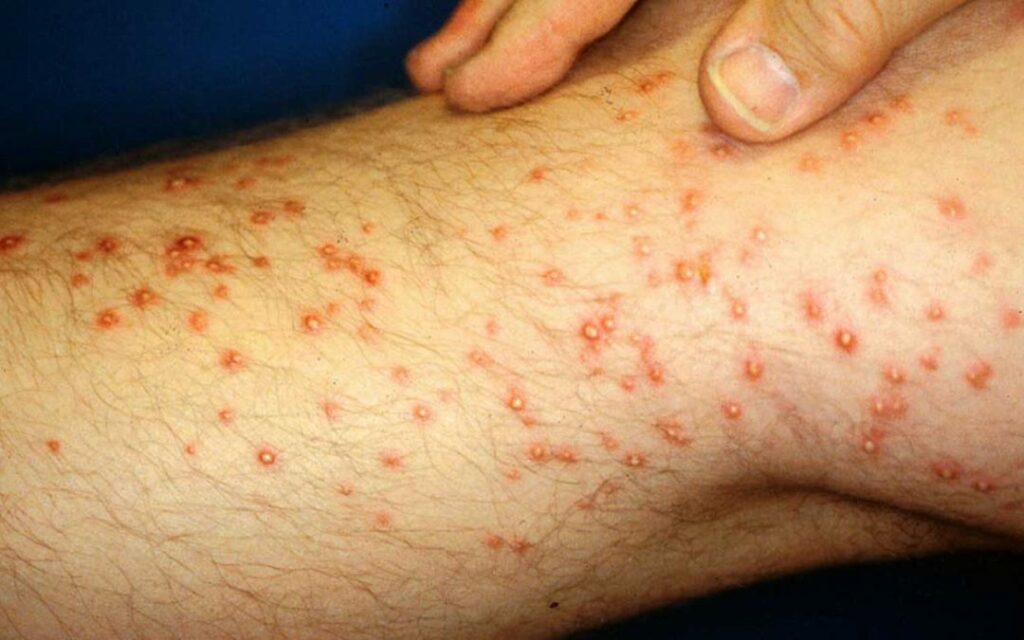 Alertan en Costa Rica luego de tres muertes por rickettsiosis | Diario ...